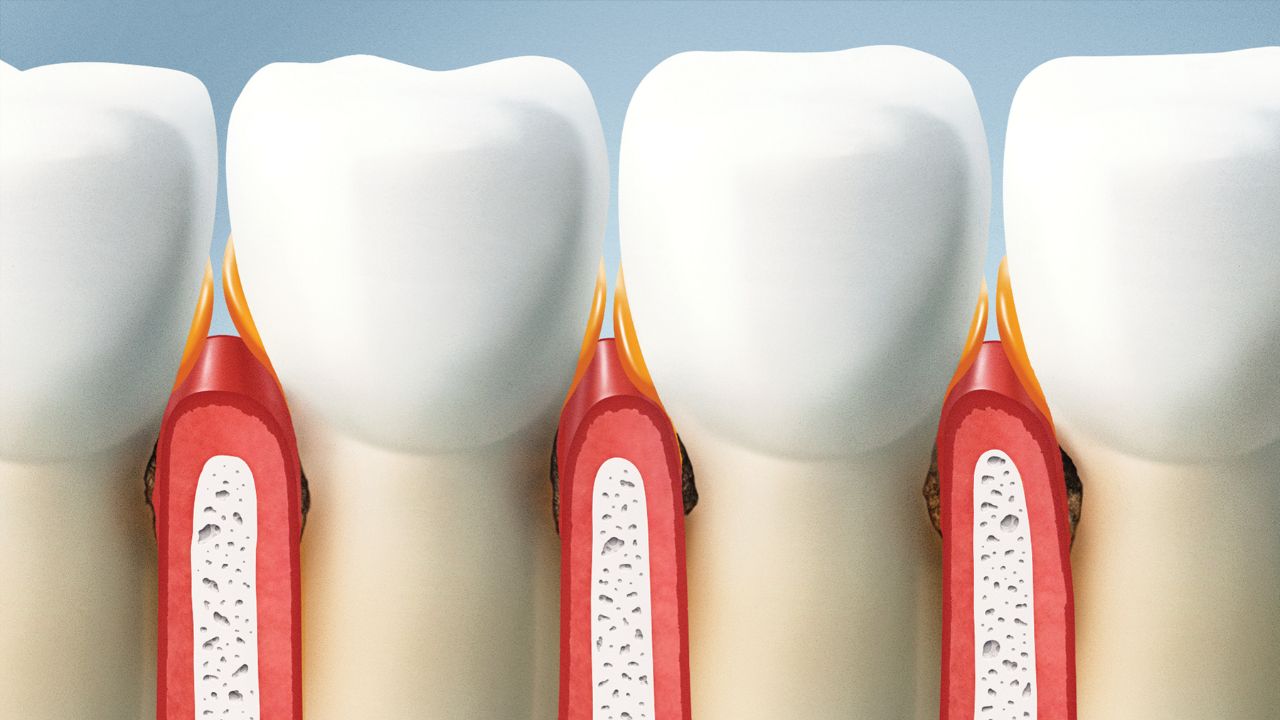 Bleeding Gums During Menopause: What You Need to Know
